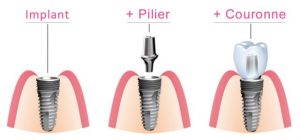 Implant dentaire tunisie : Implant dent sans douleur, prix soins dents